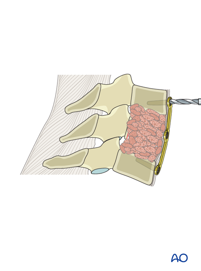 Anterior plating