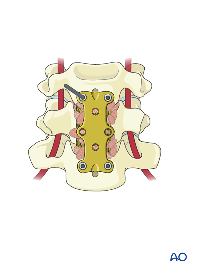Anterior plating for A2 Coronal split/pincer fracture