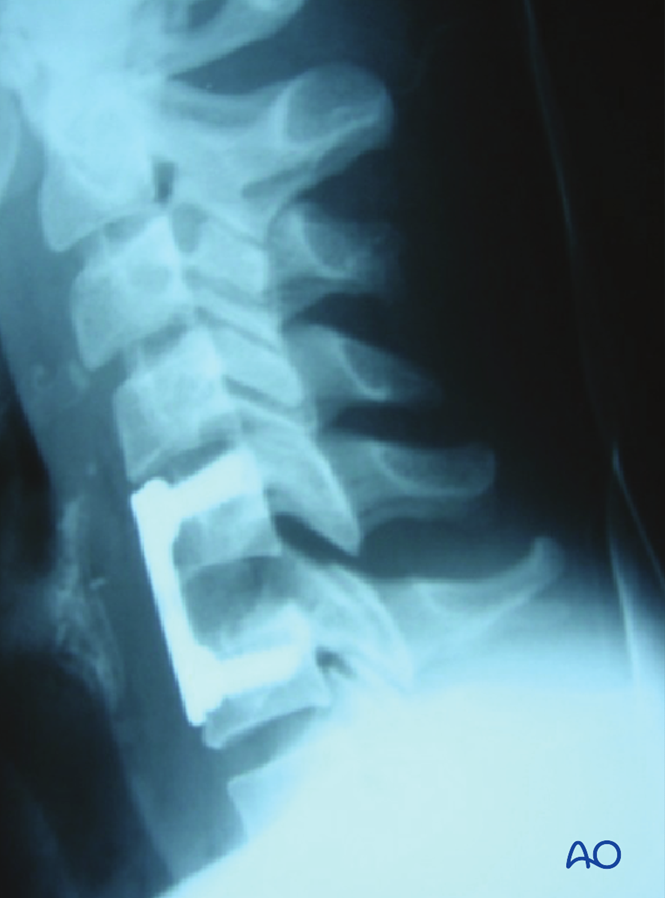 Anterior plating