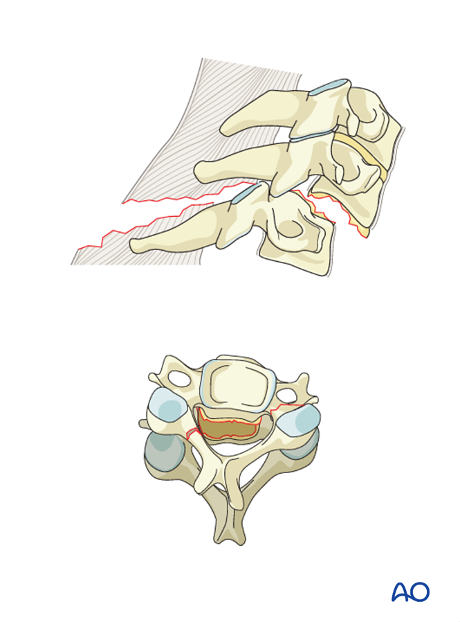 Combined anterior and posterior (360) for A2 Coronal split/pincer fracture