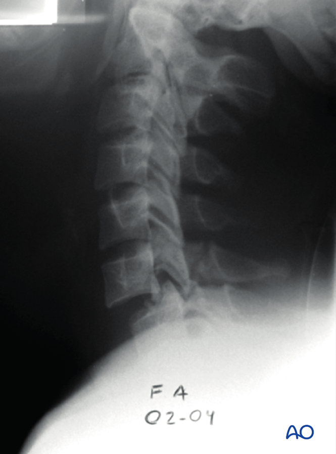 Combined anterior and posterior (360) for A2 Coronal split/pincer fracture