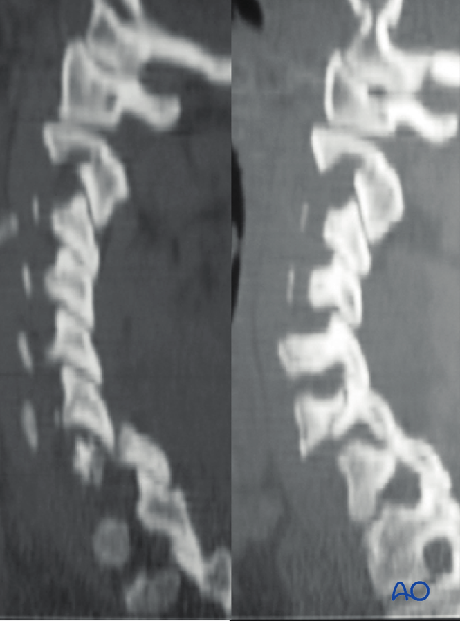 Combined anterior and posterior (360) for A2 Coronal split/pincer fracture