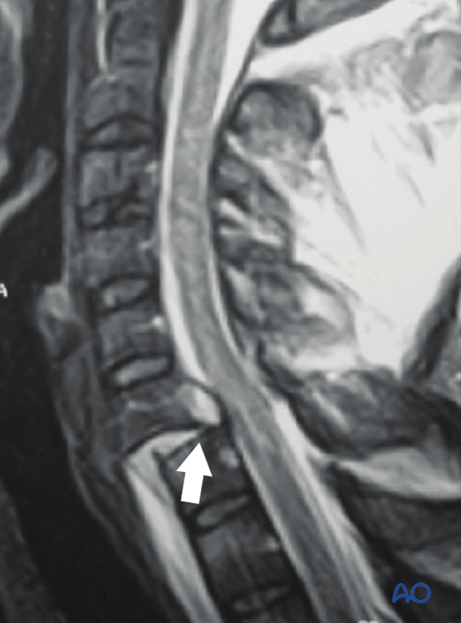 Combined anterior and posterior (360) for A2 Coronal split/pincer fracture