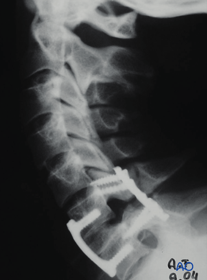 Combined anterior and posterior (360) for A2 Coronal split/pincer fracture
