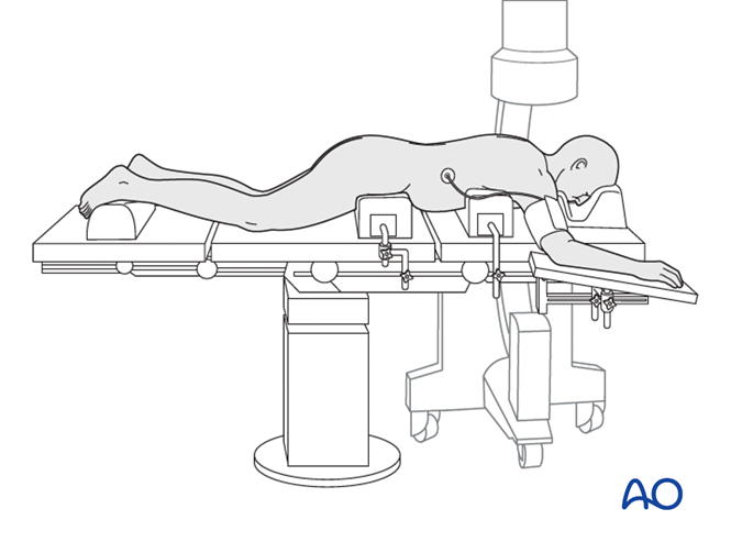 Pedicle screw insertion in T1–T3