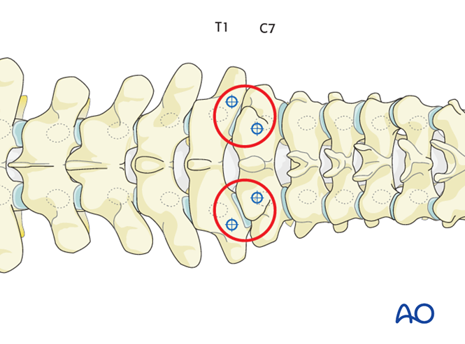 Pedicle screw insertion in T1–T3