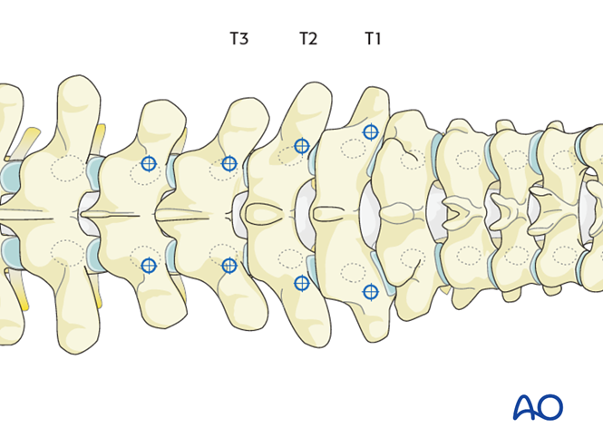 Pedicle screw insertion in T1–T3