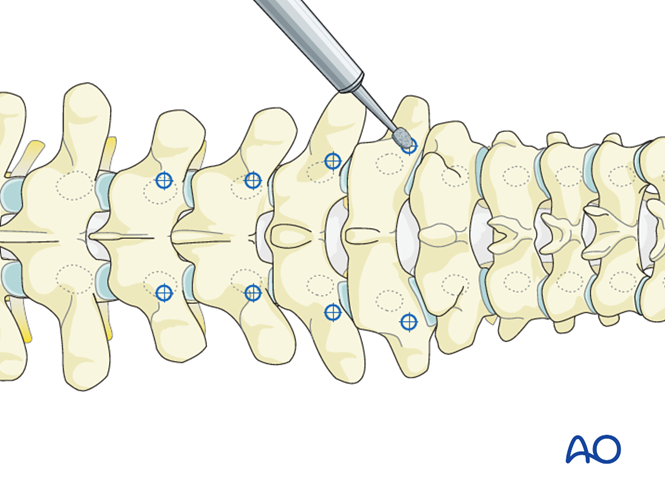 Pedicle screw insertion in T1–T3