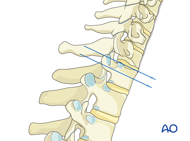 Pedicle screw insertion in T1–T3
