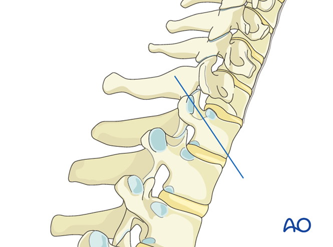 Pedicle screw insertion in T1–T3