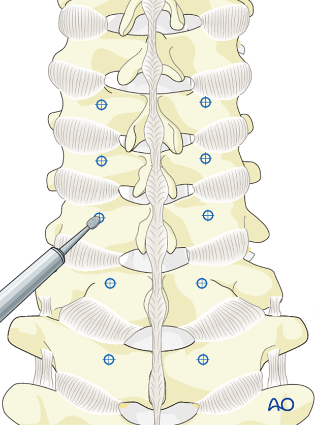 Lateral mass screw insertion (Magerl technique)