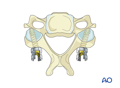 Lateral mass screw insertion (Magerl technique)