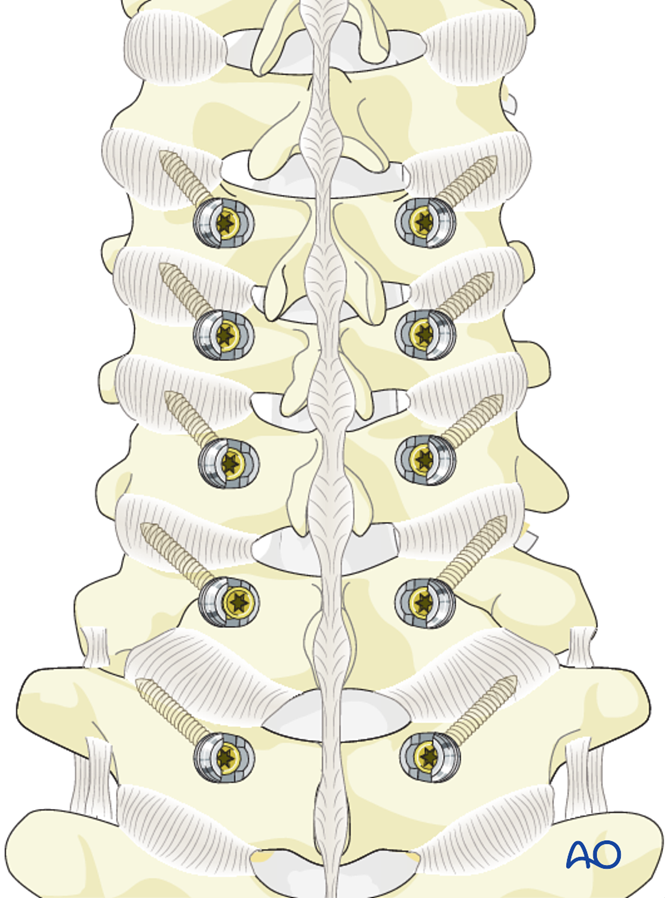Lateral mass screw insertion (Magerl technique)