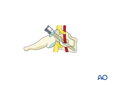 Pedicle screw insertion in the cervical spine