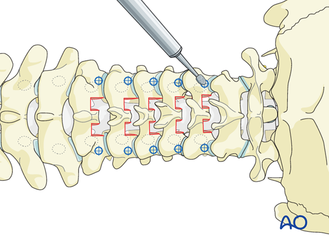 Pedicle screw insertion in the cervical spine