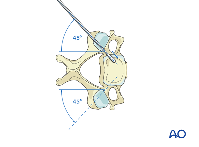 Pedicle screw insertion in the cervical spine
