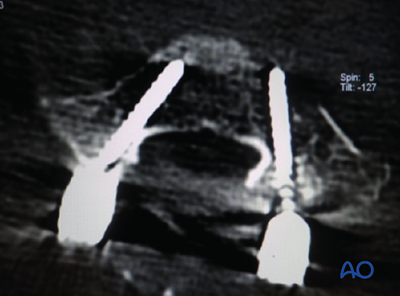 Pedicle screw insertion in the cervical spine