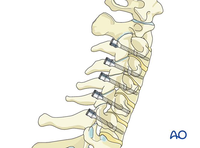 Pedicle screw insertion in the cervical spine