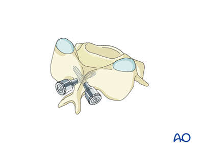 Laminar screw insertion in T1 and T2
