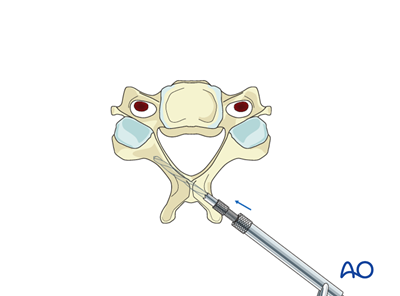 Laminar screw insertion in T1 and T2
