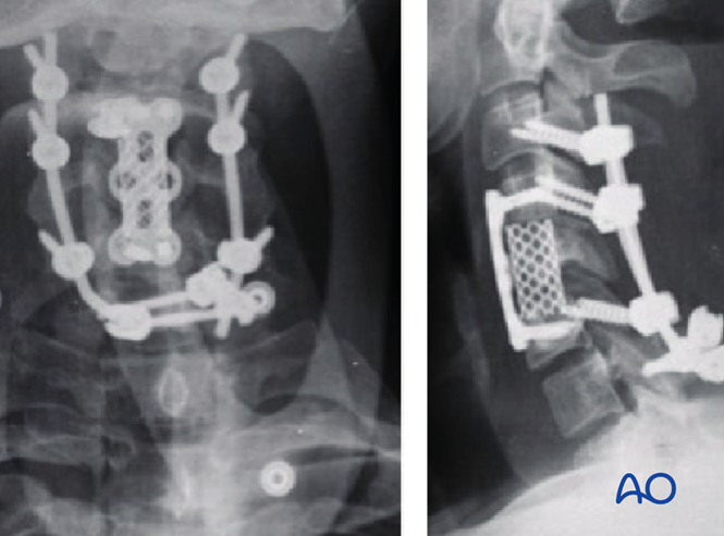 Laminar screw insertion in T1 and T2