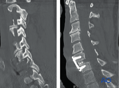 Postoperative cervical deformities