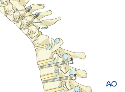 Postoperative cervical deformities