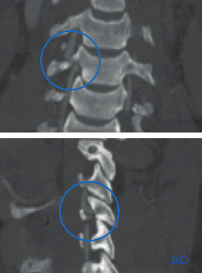 Surgical complications associated with cervical trauma surgery