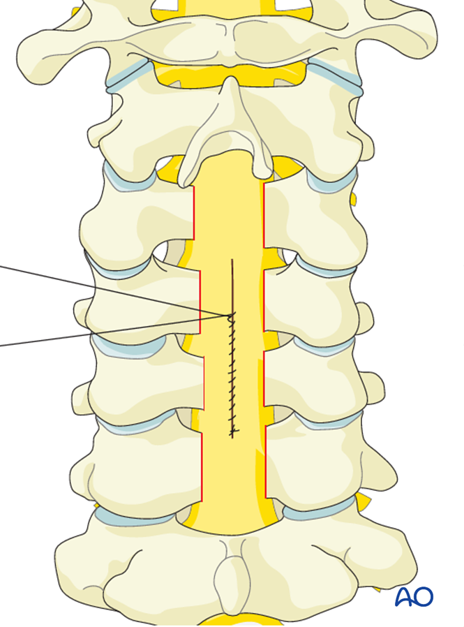 Surgical complications associated with cervical trauma surgery