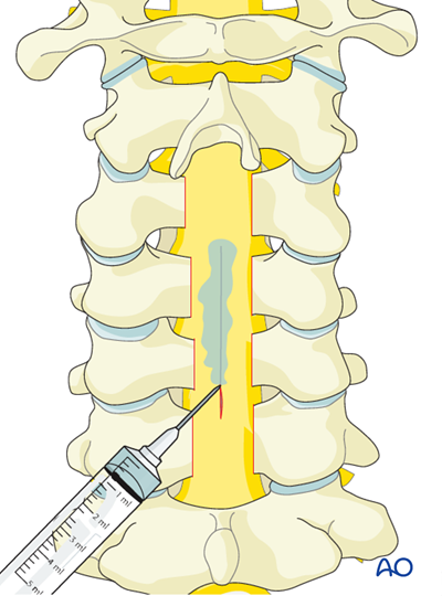 Surgical complications associated with cervical trauma surgery
