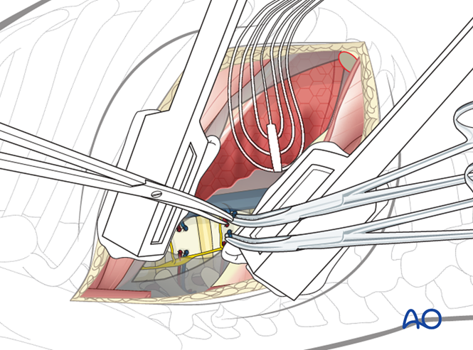 Right sided thoracotomy (T3-T10)