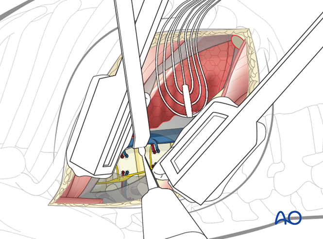 Right sided thoracotomy (T3-T10)