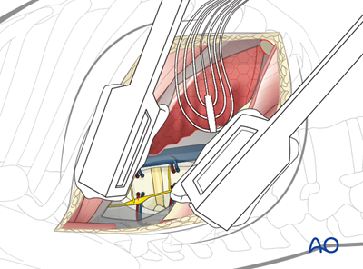 Right sided thoracotomy (T3-T10)