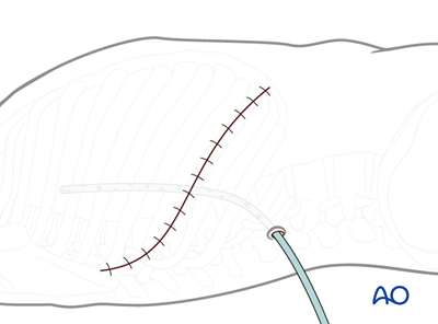 Right sided thoracotomy (T3-T10)