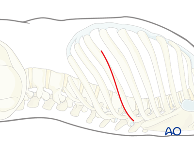 Left sided thoracotomy (T3-L1/2)