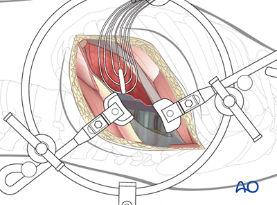 Left sided thoracotomy (T3-L1/2)
