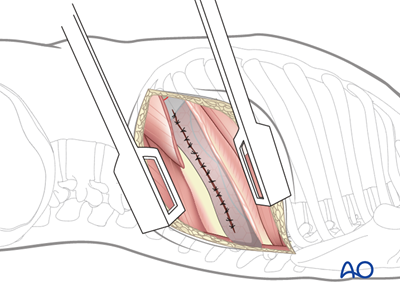 Left sided thoracotomy (T3-L1/2)