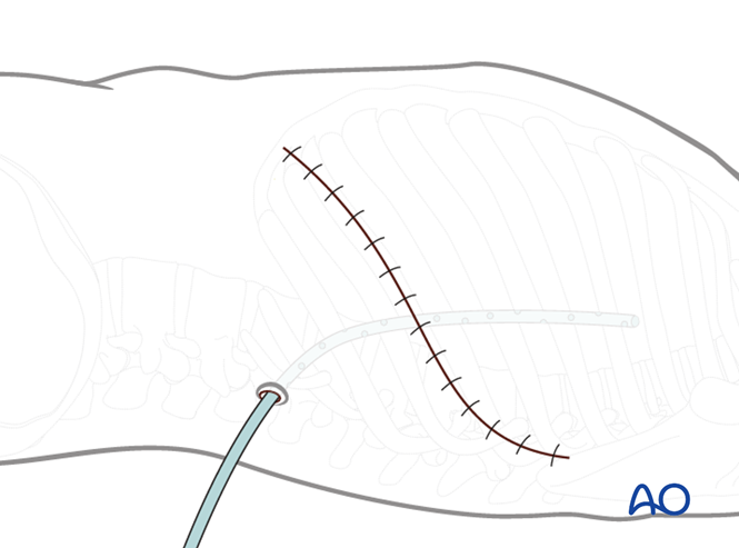 Left sided thoracotomy (T3-L1/2)
