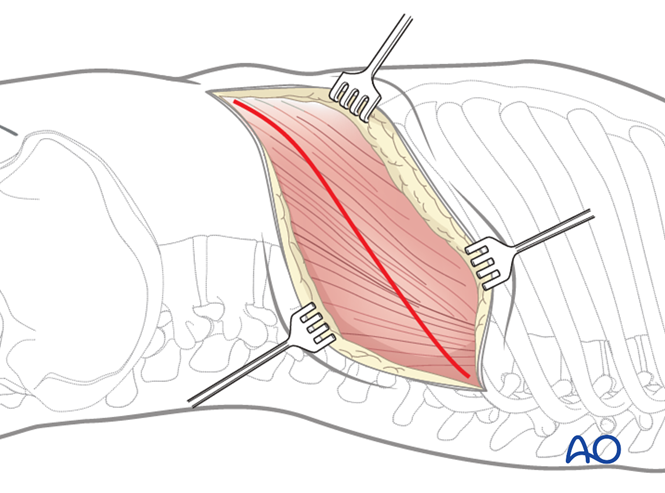 Left sided thoracolumbar junction approach (T10-L2)