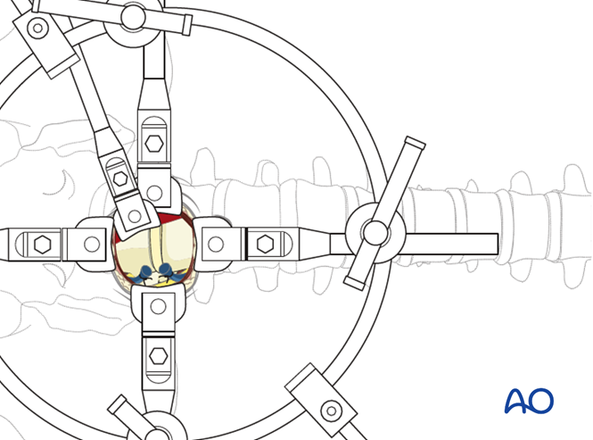 Mini open retroperitoneal approach (L4-S1)