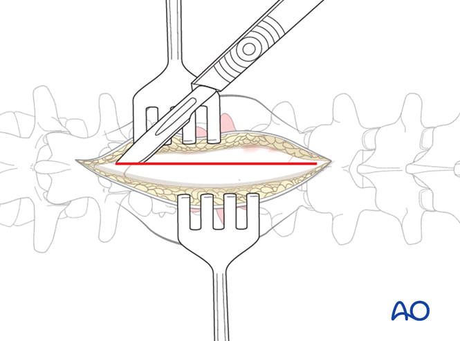 Posterior open approach - midline approach (T1-S1)