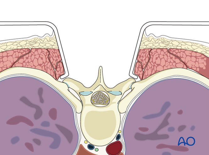 Posterior open approach - midline approach (T1-S1)