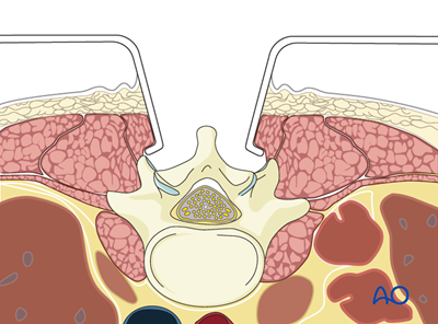 Posterior open approach - midline approach (T1-S1)