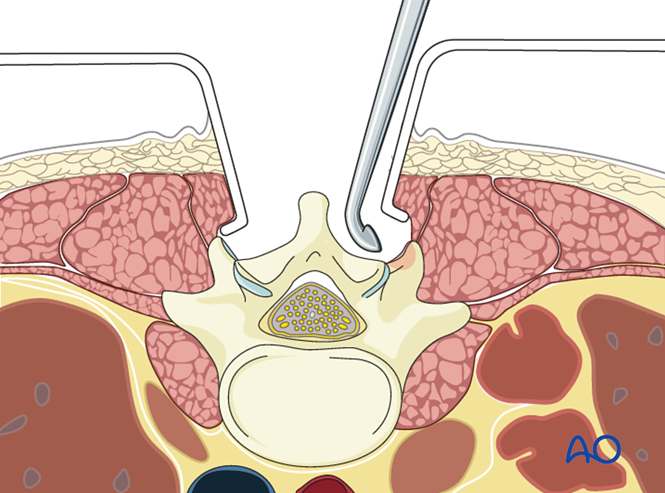 Posterior open approach - midline approach (T1-S1)