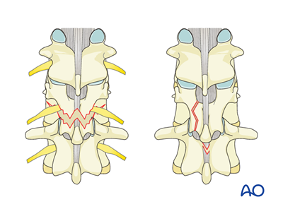 Posterior open approach - midline approach (T1-S1)