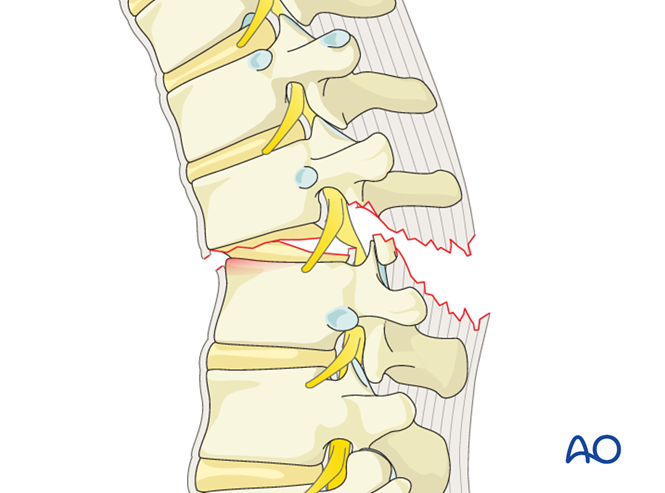 Posterior open approach - midline approach (T1-S1)