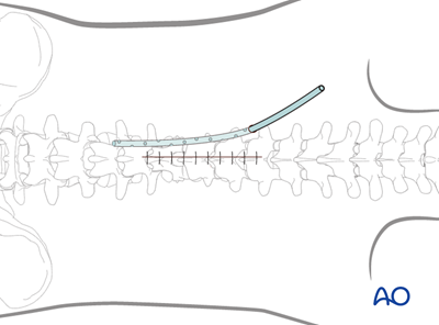 Posterior open approach - midline approach (T1-S1)