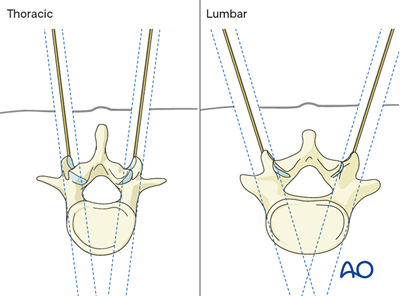 Percutaneous posterior approach for pedicle screw placement
