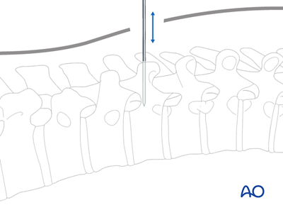 Percutaneous posterior approach for pedicle screw placement