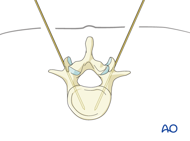 Percutaneous posterior approach for pedicle screw placement